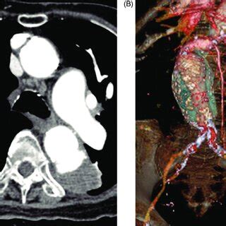Preoperative Computed Tomography CT Images Of Aneurysms A Saccular