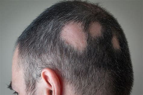 Chemotherapy Side Effects Hair Loss