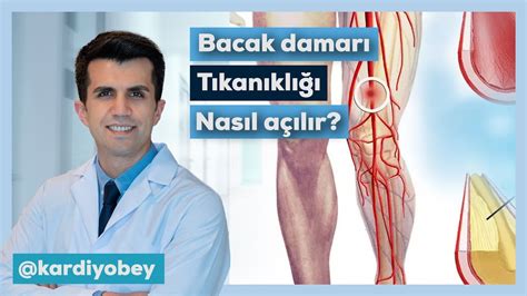 Bacak Damarı Tıkanıklığı Nasıl Açılır YouTube