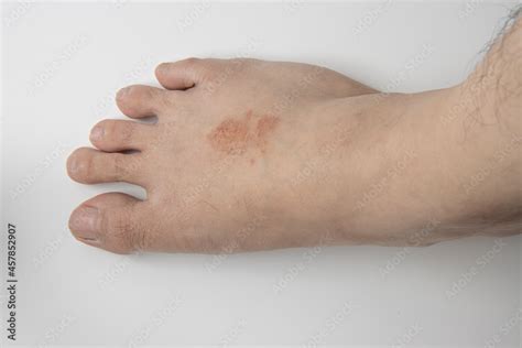 Top View Of Foot Infected With Ringworm Athlete S Foot Or Tinea Pedis