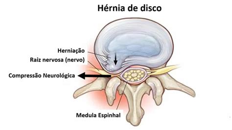 Dor Ciática ou Ciatalgia Quais são as suas causas