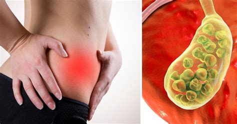 Síntomas de la vesícula acodada Salud180