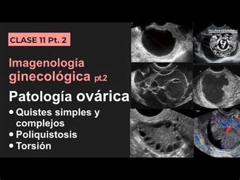Que Es Un Quiste De Ovario Simple Arcon