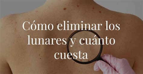Cómo eliminar los lunares y cuánto cuesta