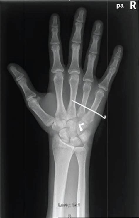 A B X Ray Right Hand PA And Oblique 4 Weeks Postoperatively