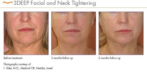 Endymed Deep Rf Skin Tightening Genesis Medi Clinic