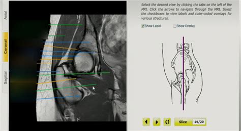Hip Mri Frontal Plane Slice Diagram Quizlet