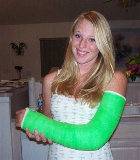 Albums Pictures Pictures Of Arm Cast Updated