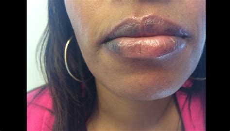 What Causes Pigmentation Of The Lips Lipstutorial Org