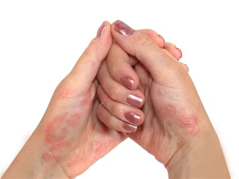Il Prurito Alle Mani Cause Sintomi E Rimedi