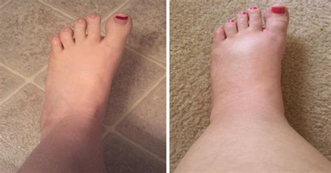 Build A Info About How To Get Rid Of A Swollen Knee Gununique