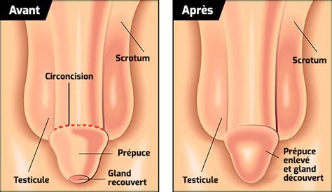 Tout comprendre à la circoncision Stop aux violences obstetricales
