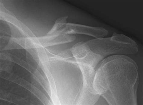 FRACTURA DE CLAVÍCULA FISIOTERAPIA Y REHABILITACIÓN