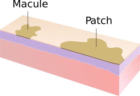 Ha Primary Skin Lesions Flashcards Quizlet