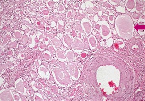 Path 5c Renal Flashcards Quizlet
