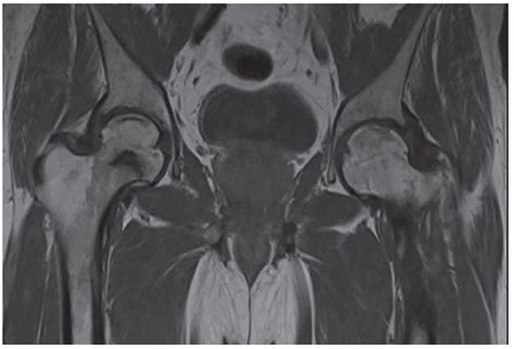 Avascular Necrosis Of Femoral Head Mri