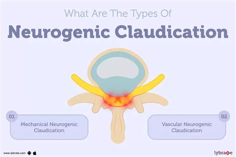 Neurogenic Claudication Causes Symptoms Treatment And Cost
