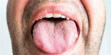 Qué hago si tengo lengua agrietada Ferrus Bratos