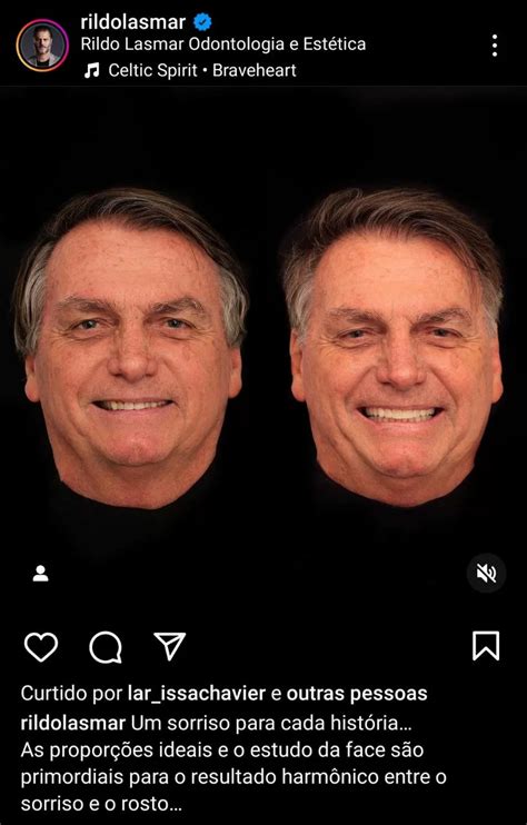 Ex presidente Bolsonaro gasta 84 mil reais em procedimento estético de