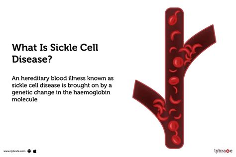 Sickle Cell Disease Causes Symptoms Treatment And Cost