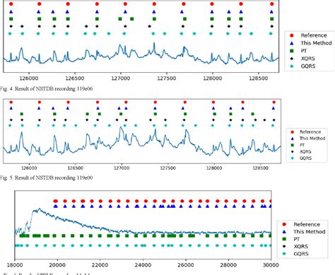 robust arrhythmia classification based on qrs detecti