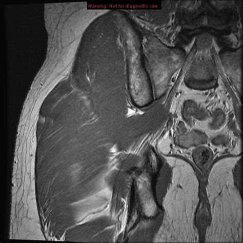 Hip MRI Anatomy Coronal 10 Posterior Diagram Quizlet