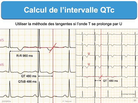 Intervalle QT 2 QT corrigé QTc e cardiogram