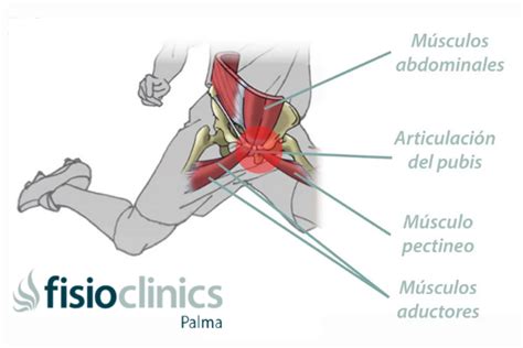 Osteopatía de pubis o pubalgia Síntomas y causas Tratamiento en