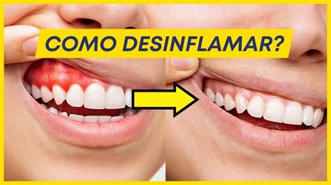 Como Tratar A Gengiva Inflamada Do Paciente Youtube