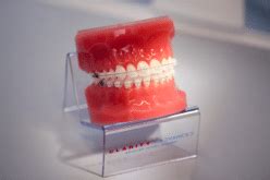 Aparat Dentar Pret Cat Costa Un Aparat Dentar