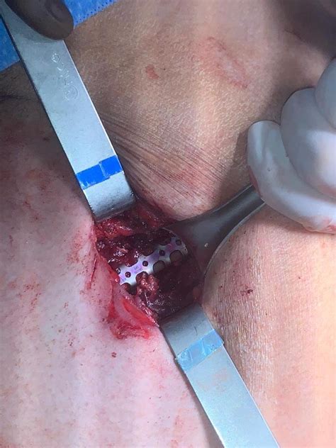 Fijaci N Costal Fractura De Costillas Dr Israel Hern Ndez