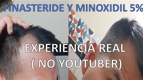 PRIMER MES DE MINOXIDIL Y FINASTERIDE CASO REAL YouTube
