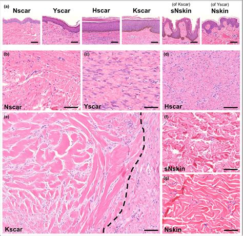 Keloid Histology
