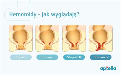 Hemoroidy Czym S Jak Wygl Daj Objawy Hemoroid W Aptelia Pl