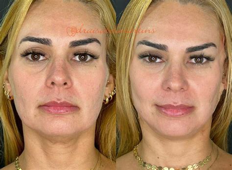 LIFTING FACIAL CMA