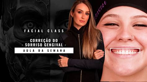 Tratamento De Sorriso Gengival Toxina Botul Nica Youtube