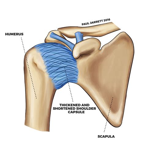 Mr Paul Jarrett Adhesive Capsulitis Frozen Shoulder Murdoch