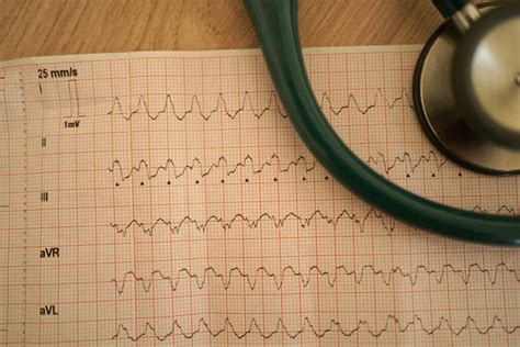 Wide Qrs Complex Tachycardia