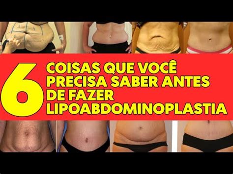 SEIS COISAS QUE VOCÊ PRECISA SABER ANTES DE SUA LIPOABDOMINOPLASTIA