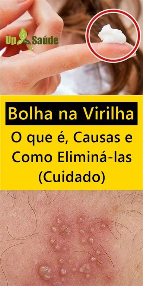 Bolha na Virilha O que é Causas e Como Eliminá las Cuidado em