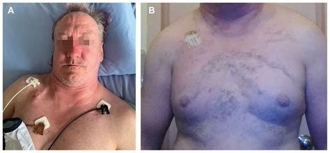 Catheter Associated Superior Vena Cava Syndrome Cmaj