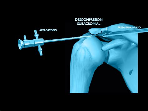 Dr Carlos Godoy Síndrome de Pinzamiento Subacromial