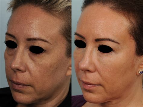 Photos de lipofilling du visage avant et après