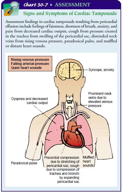 Pericardial Effusion And Cardiac Tamponade