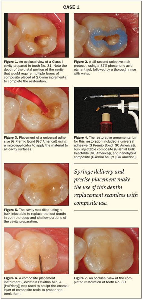 Glass Ionomer Can Be Used For Class Restorations