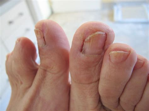 Tratamiento quirúrgico de las uñas encarnadas Centre Podomèdic