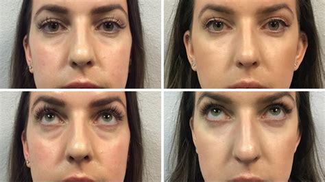 All About Under Eye Filler Restylane Before After Photos Cost