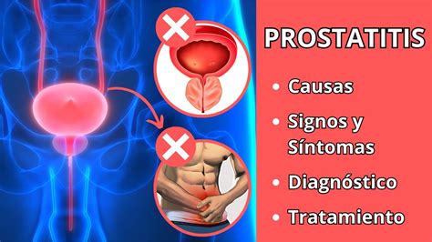 Prostatitis Causas Signos Y S Ntomas Diagn Stico Y Tratamiento