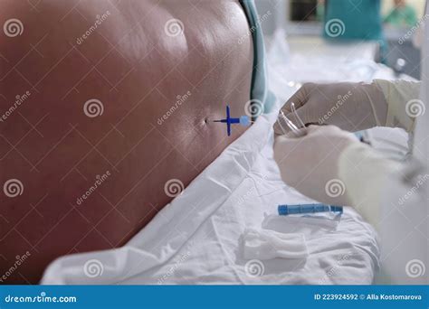 Spinale Anesthesiainjecties Van Epidurale Anesthesie Ter Voorbereiding