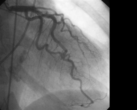 NORMAL ANGIOGRAPHY CThSurgery Cardiac Anatomy Coronary